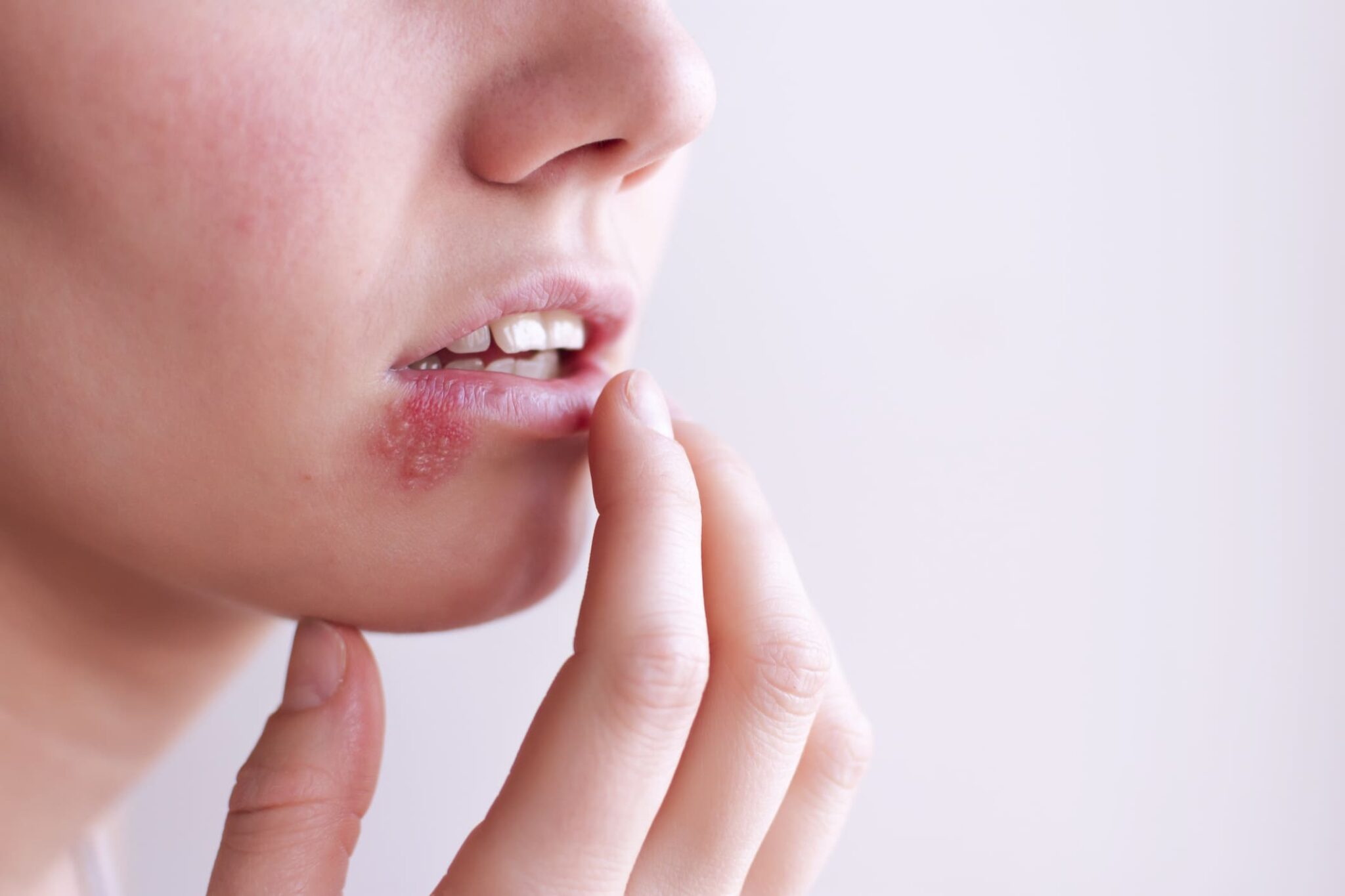 ¿Cómo se transmite la culebrilla y cómo debe tratarse? - BeHealth