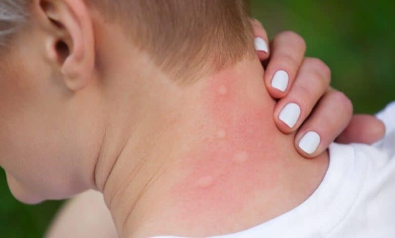 Cinco claves para comprender el prurigo nodular