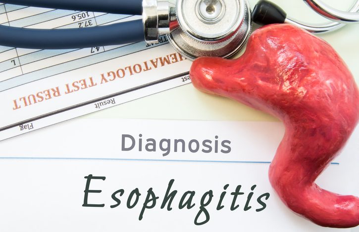 La esofagitis eosinofílica es una afección inflamatoria crónica del ...