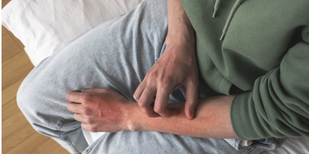 Diferencias entre el prurigo nodular y otras afecciones de la piel ...